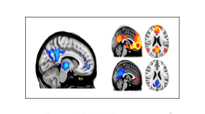 The entropic brain: a theory of conscious states informed by ...